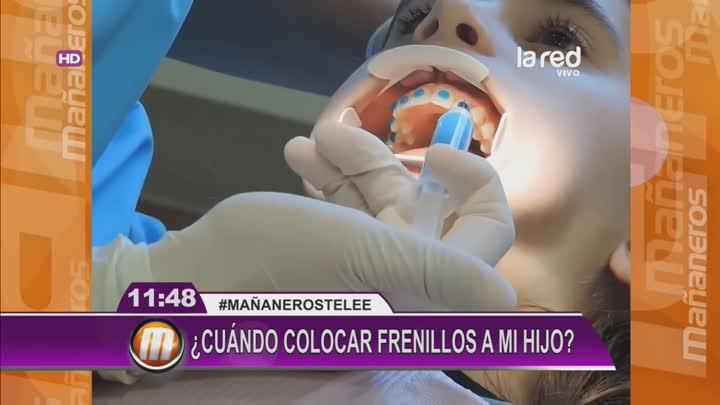 La Red - Todo lo que debes saber sobre los frenillos