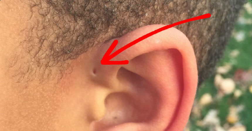 Solo 1 de cada 100 personas nace con este orificio extra en su oreja ...