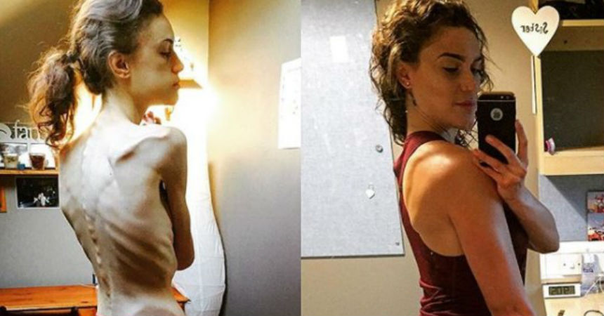 La joven con anorexia que se salvó de la muerte gracias a las fotos de ...