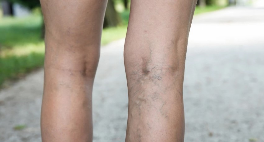 ¿Qué son las varices y por qué surgen? - La Red
